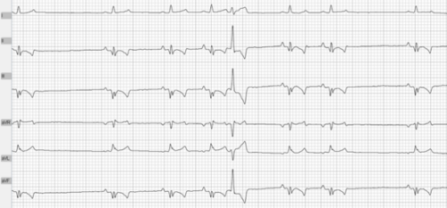A Vizsla with Ventricular Premature Complexes
