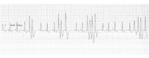 A Vizsla with Ventricular Premature Complexes